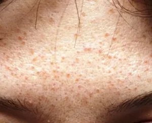 Penyebab Beruntusan di Jidat dan Cara Mengatasinya - Gramedia