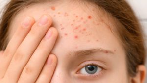 Penyebab Jerawat di Dahi dan Cara Mengatasinya - Best Seller Gramedia