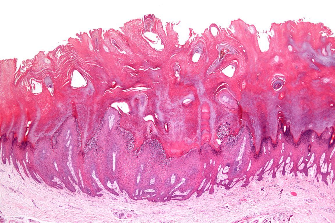 3 Jenis Kutil Berbahaya dan Cara Mengobatinya yang Tepat!